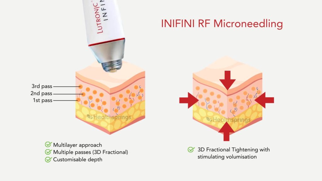 RF Microneedling in Singapore| Rejuvenate Skin | Healthsprings
