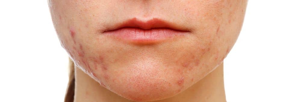 How to treat PIH (acne marks) and scars? - Healthsprings