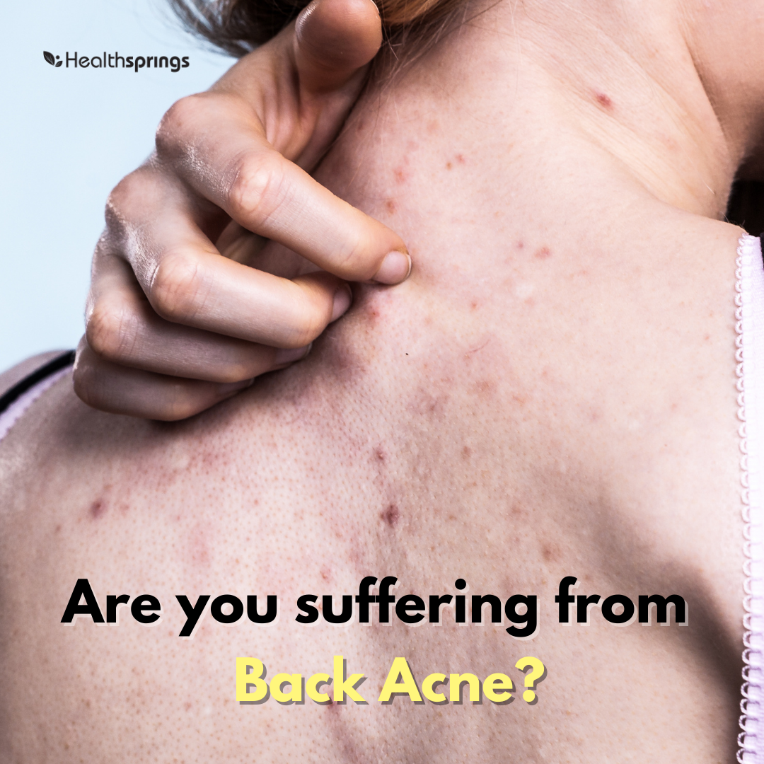 How To Treat Back Acne? - Healthsprings