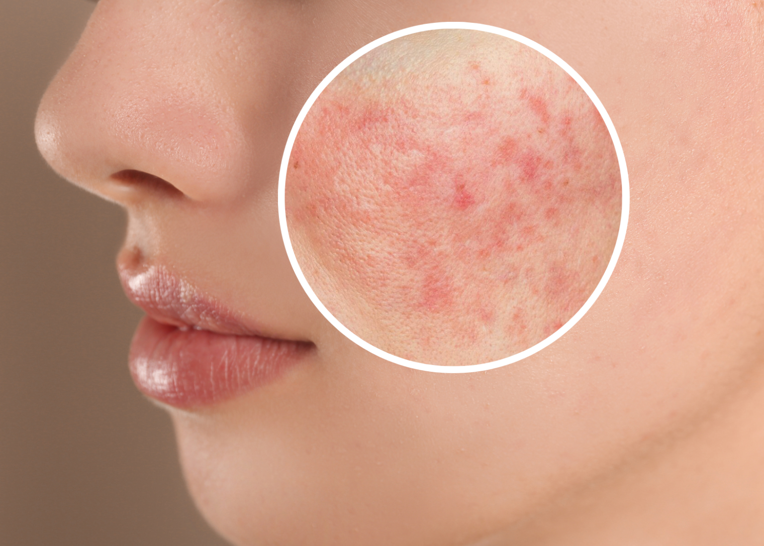 Rosacea Treatment in Singapore | Healthspring